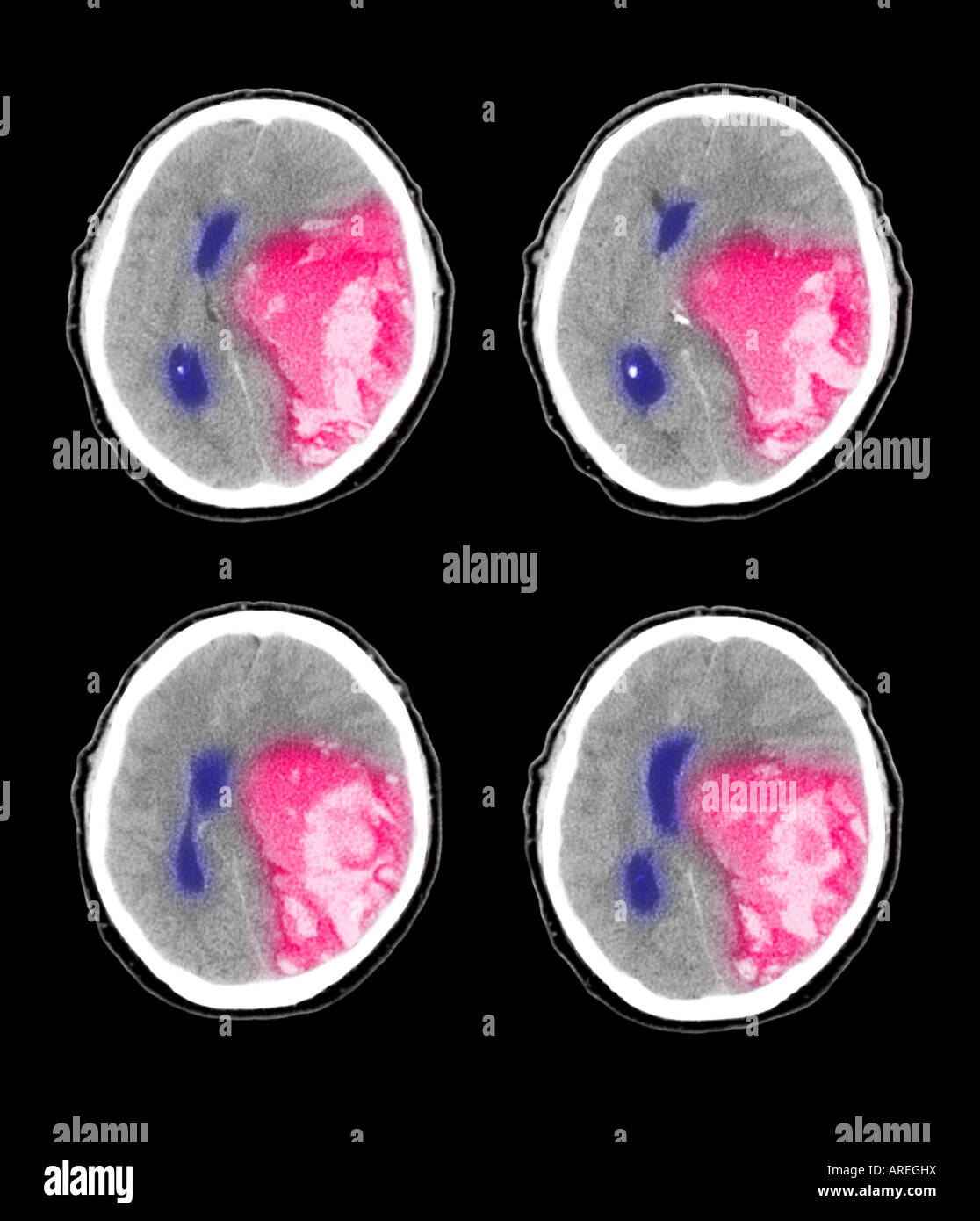 CT scanner des images montrant un AVC hémorragique dans un homme de 73 ...