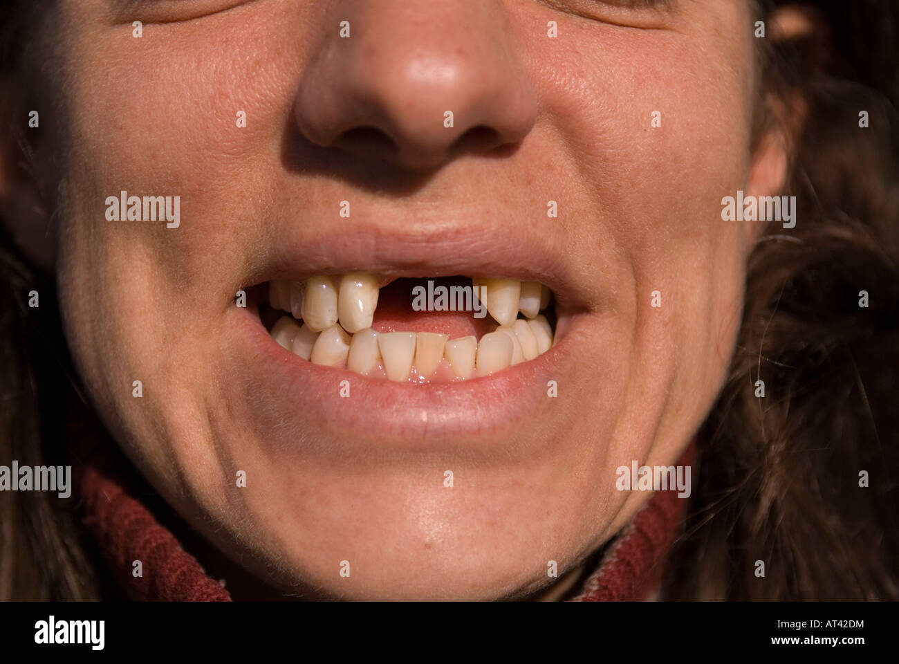 Woman missing teeth Banque de photographies et d’images à haute ...