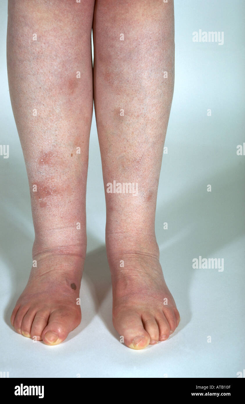 Vasculitis of legs Banque de photographies et d’images à haute ...