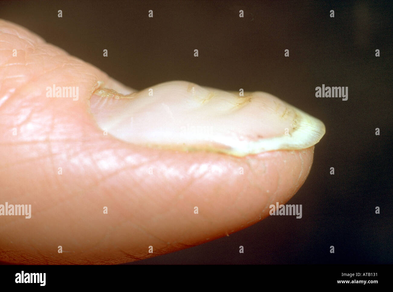 Psoriasis nails Banque de photographies et d’images à haute résolution ...