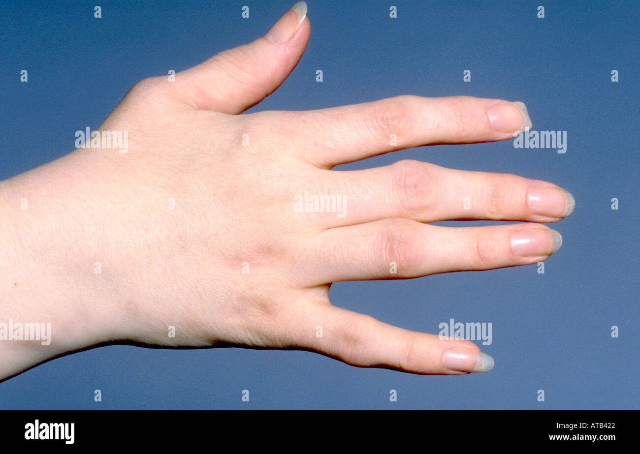 La vascularite de la polyarthrite rhumatoïde, victime d'arthrite Photo ...