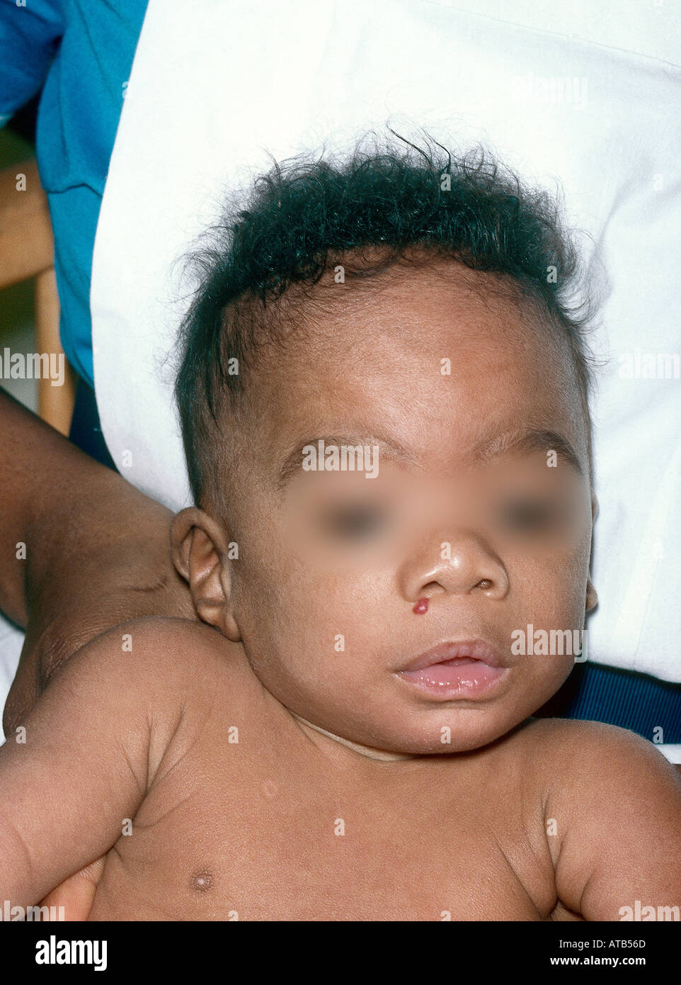 Syndrome d'alcoolisme foetal Banque de photographies et d’images à ...