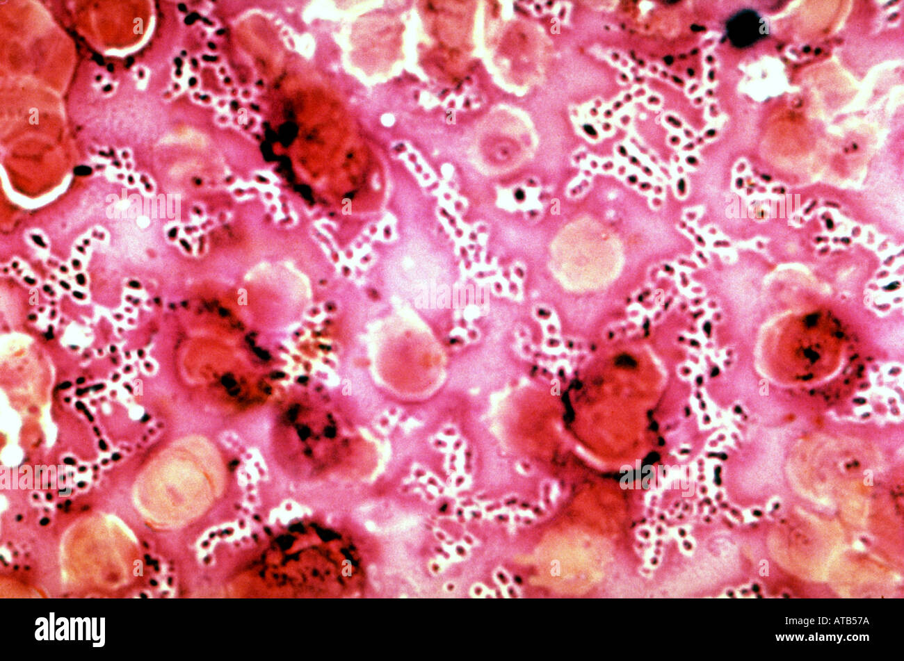 Infections à pneumocoques Banque de photographies et d’images à haute ...