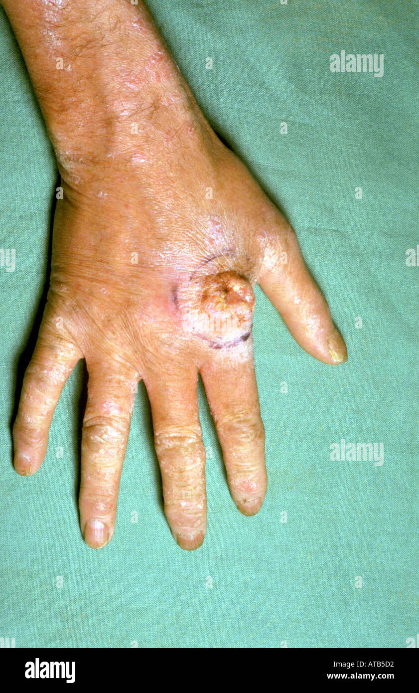 Carcinome Épidermoïde Banque d'image et photos - Alamy