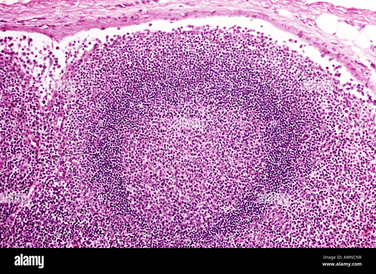 Lymph node micrograph Banque de photographies et d’images à haute ...