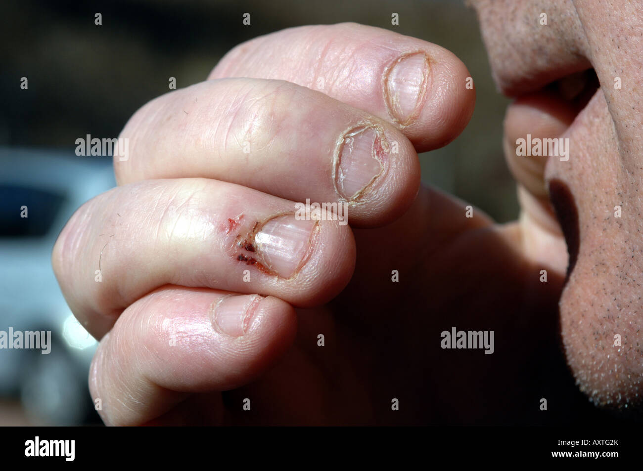 Chewing nails Banque de photographies et d’images à haute résolution ...