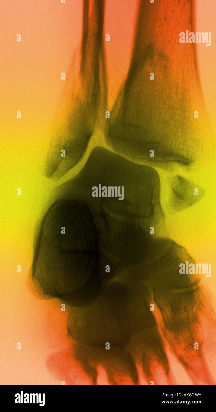 X-ray colorisée d'une fracture bimalléolaire cheville montrant les ...