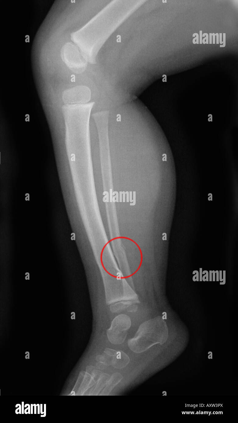 X-ray d'un enfant montrant une fracture du tibia et du péroné de la ...
