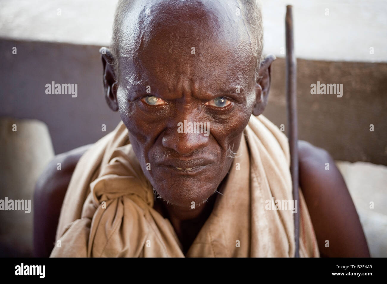 Un homme souffrant des effets du trachome attend à l'extérieur d'une ...