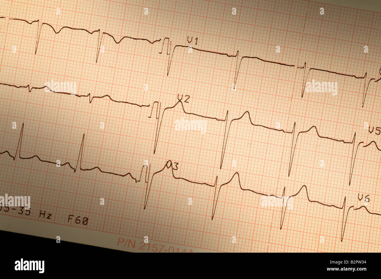 Electrocardiogram monitoring Banque de photographies et d’images à ...