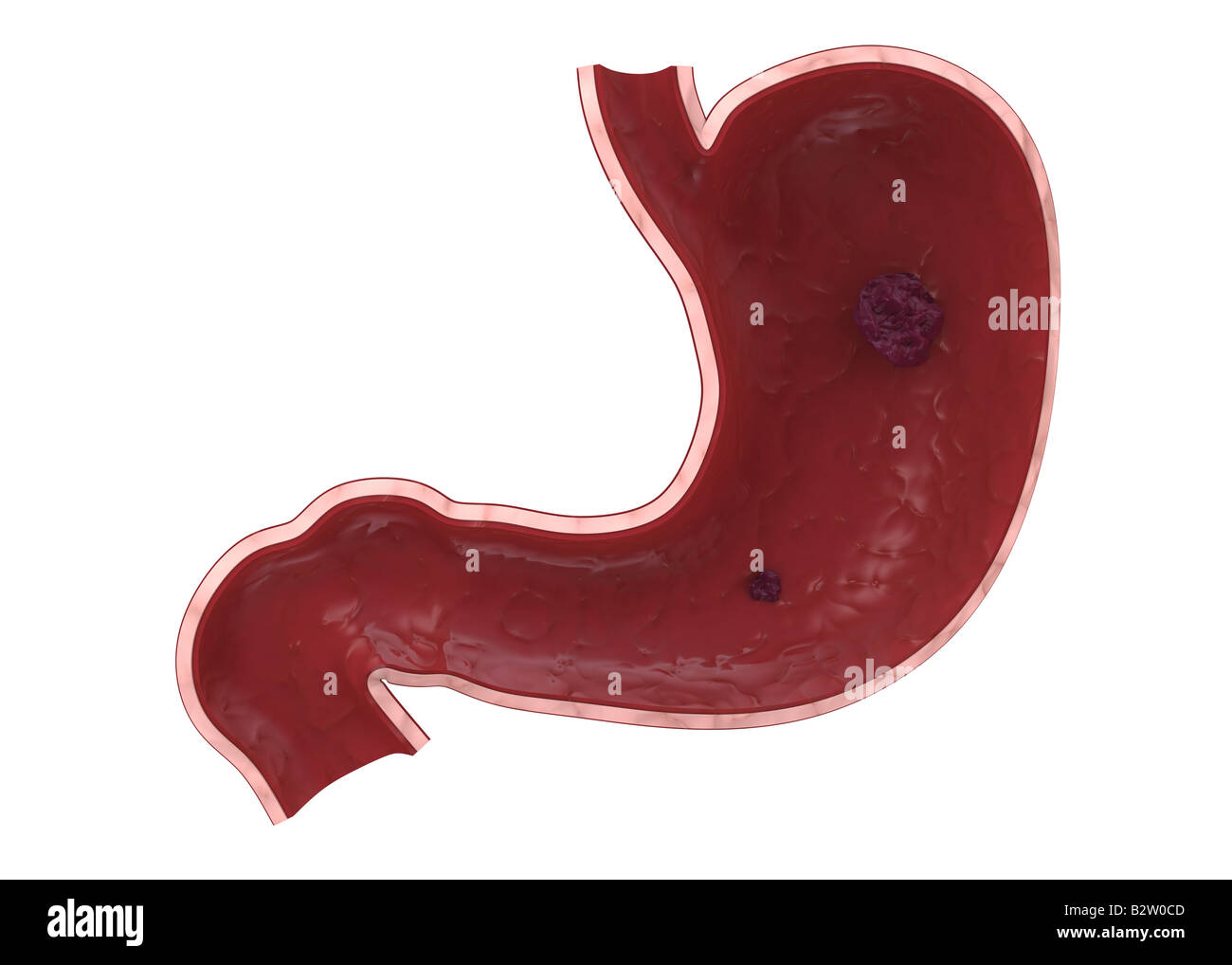 Tumeur et ulcère Banque de photographies et d’images à haute résolution ...