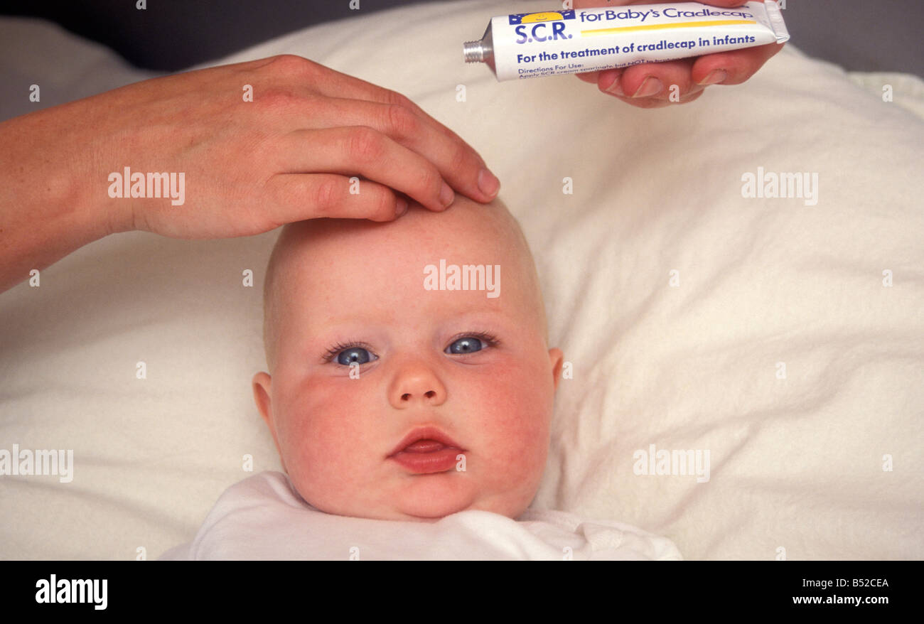 Pityriasis capitis Banque de photographies et d’images à haute ...