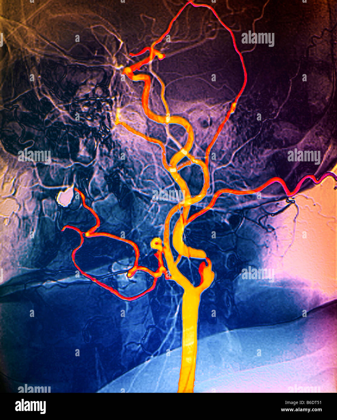 Angiogramme carotidien Banque de photographies et d’images à haute ...