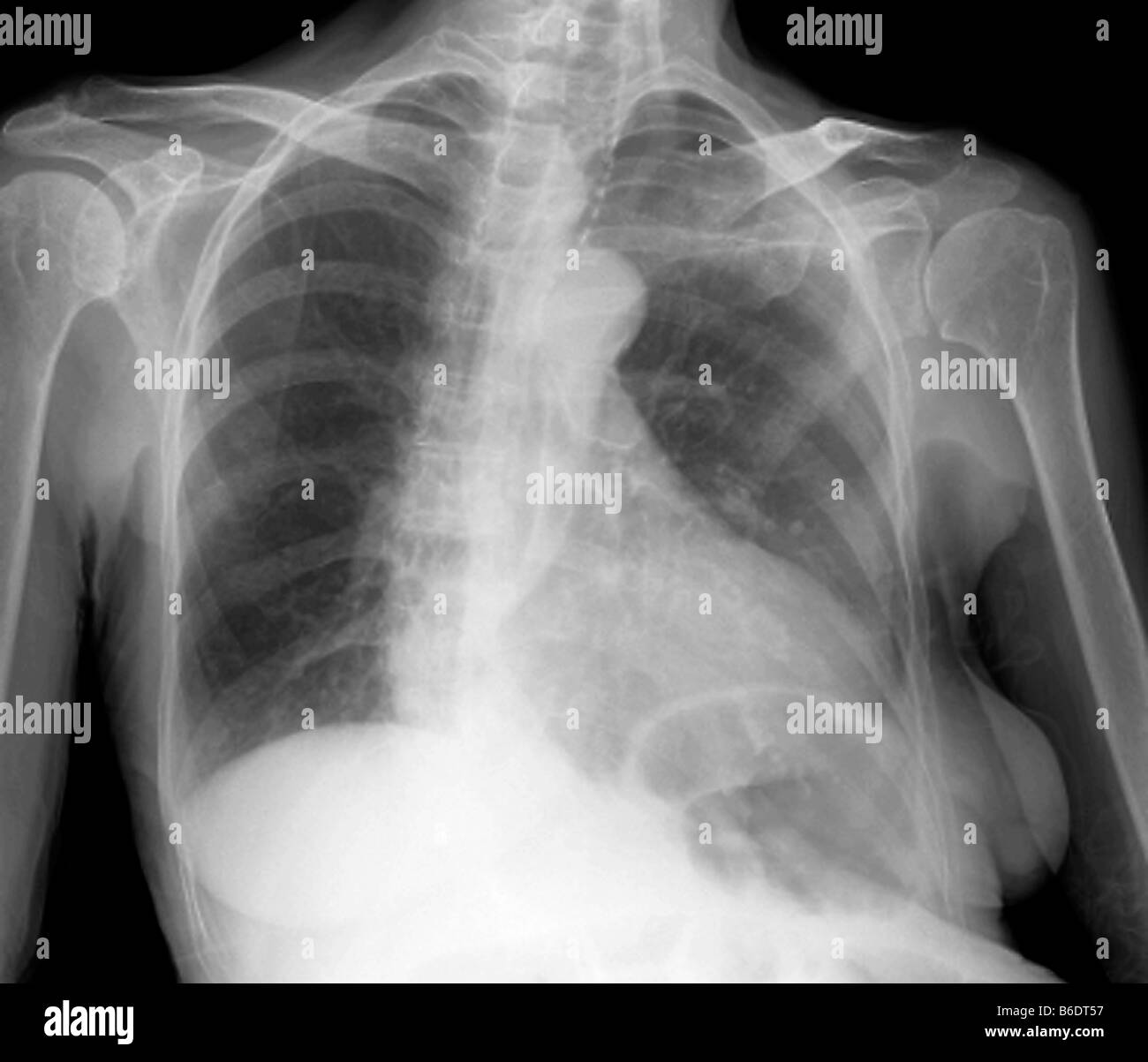 La taille du coeur. X-ray de la poitrine d'un 46-year-old patient avec ...