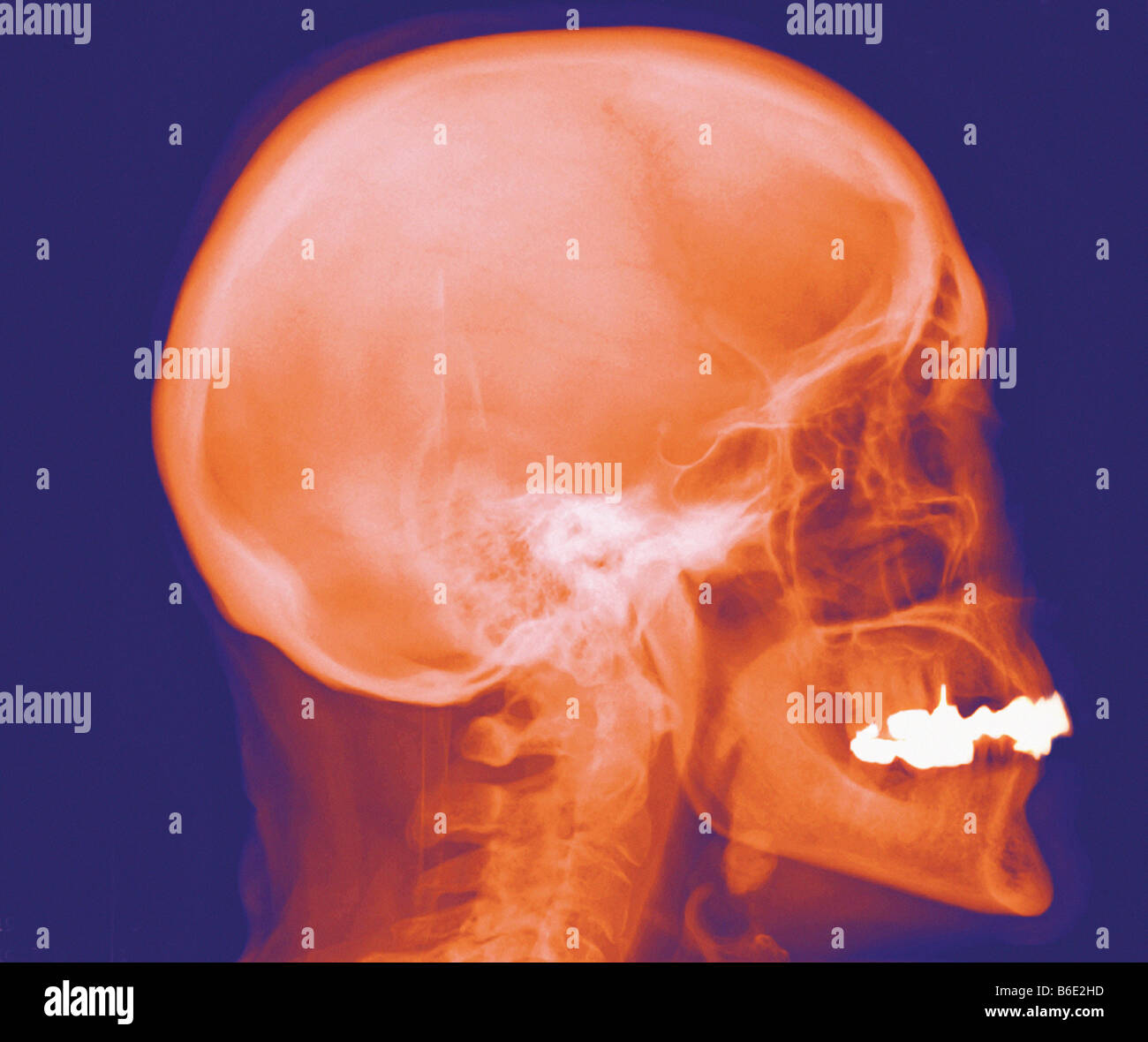 Crâne normal. Profil de couleur X-ray du crâne Photo Stock - Alamy
