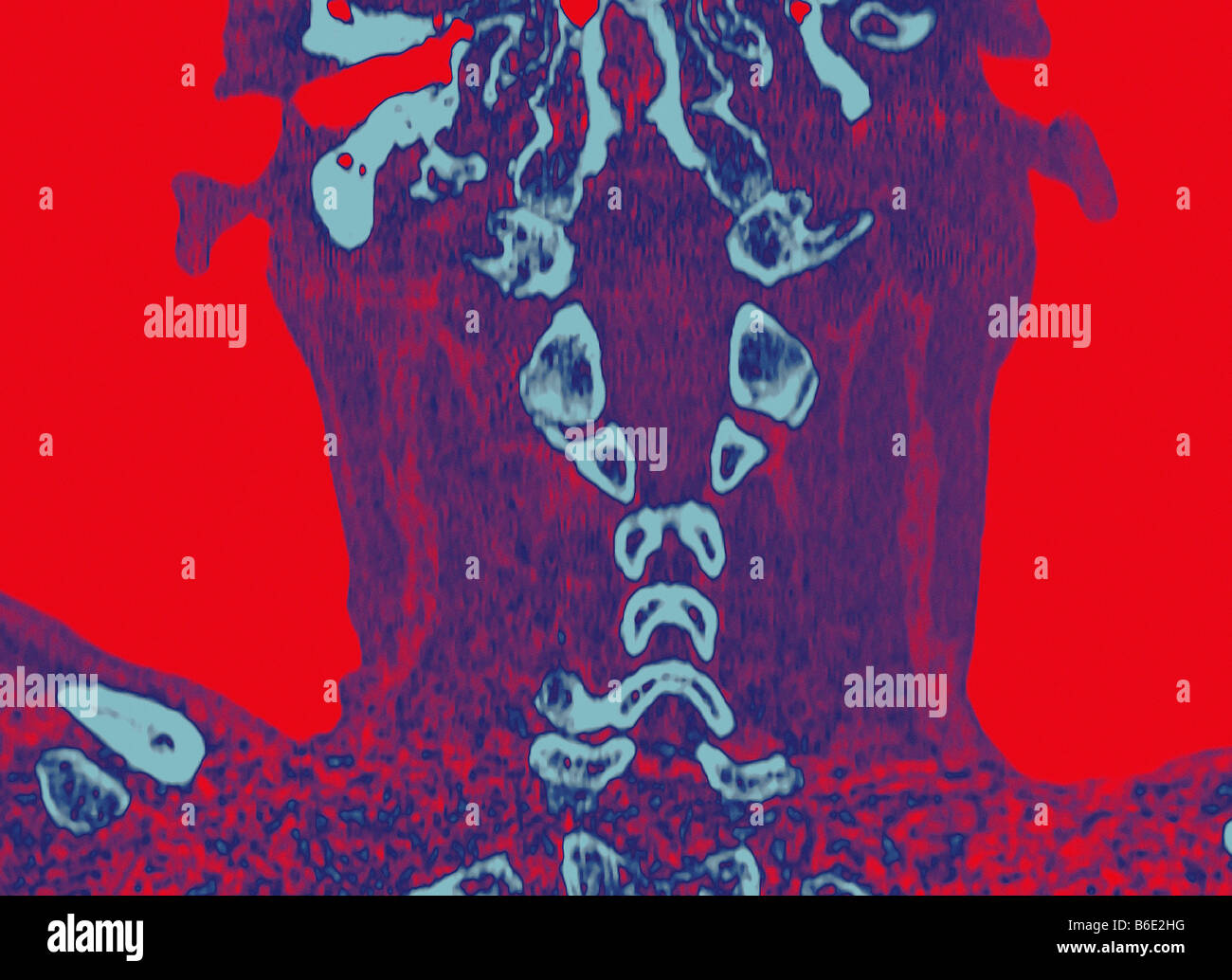 Ct colonne cervicale Banque de photographies et d’images à haute ...