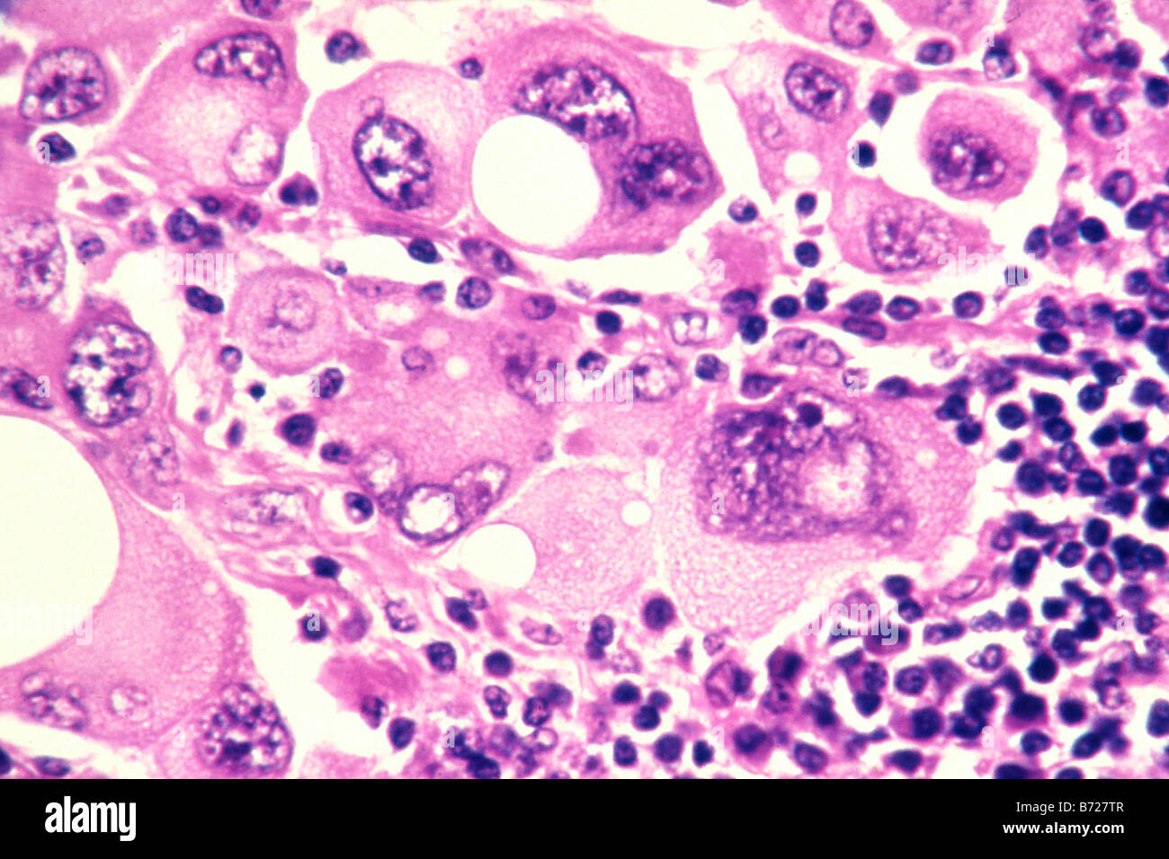 Coupe histologique par la peau montrant un mélanome malin cancer de la ...