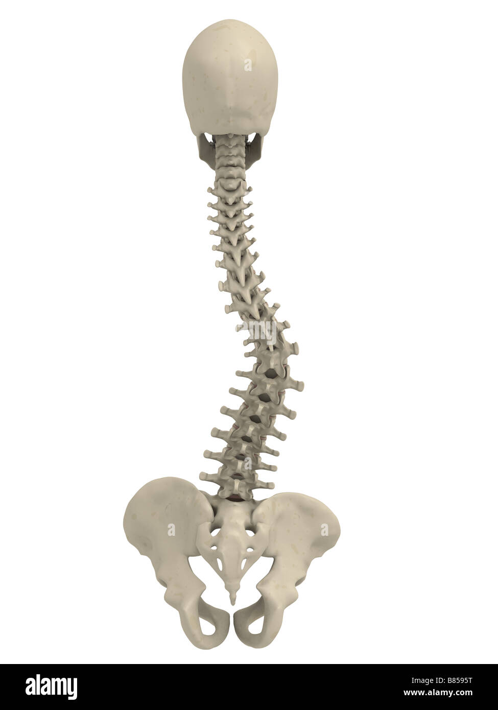 Scoliosis of the spine Banque d'images détourées - Alamy