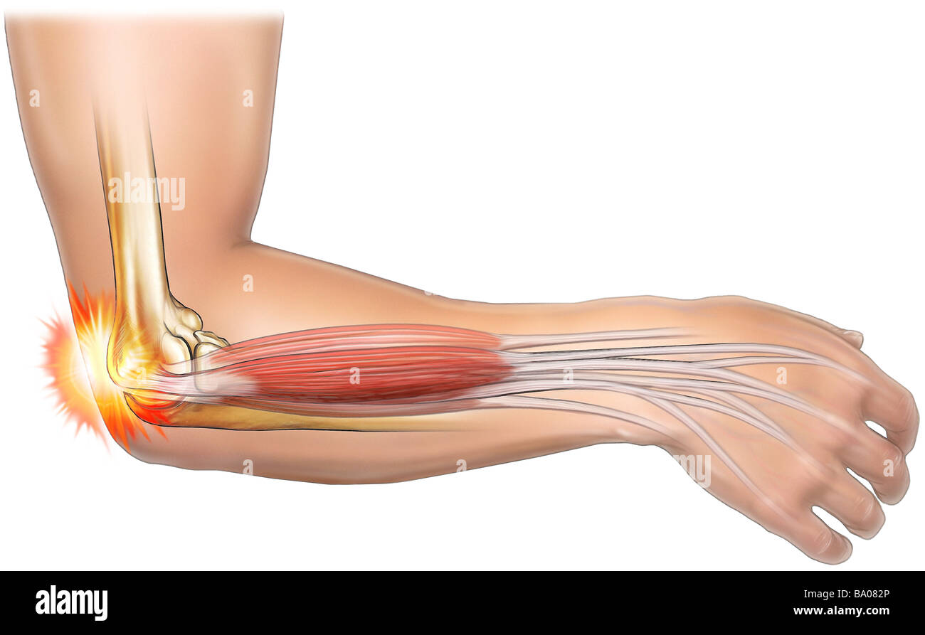 Ulnar nerve entrapment Banque de photographies et d’images à haute ...