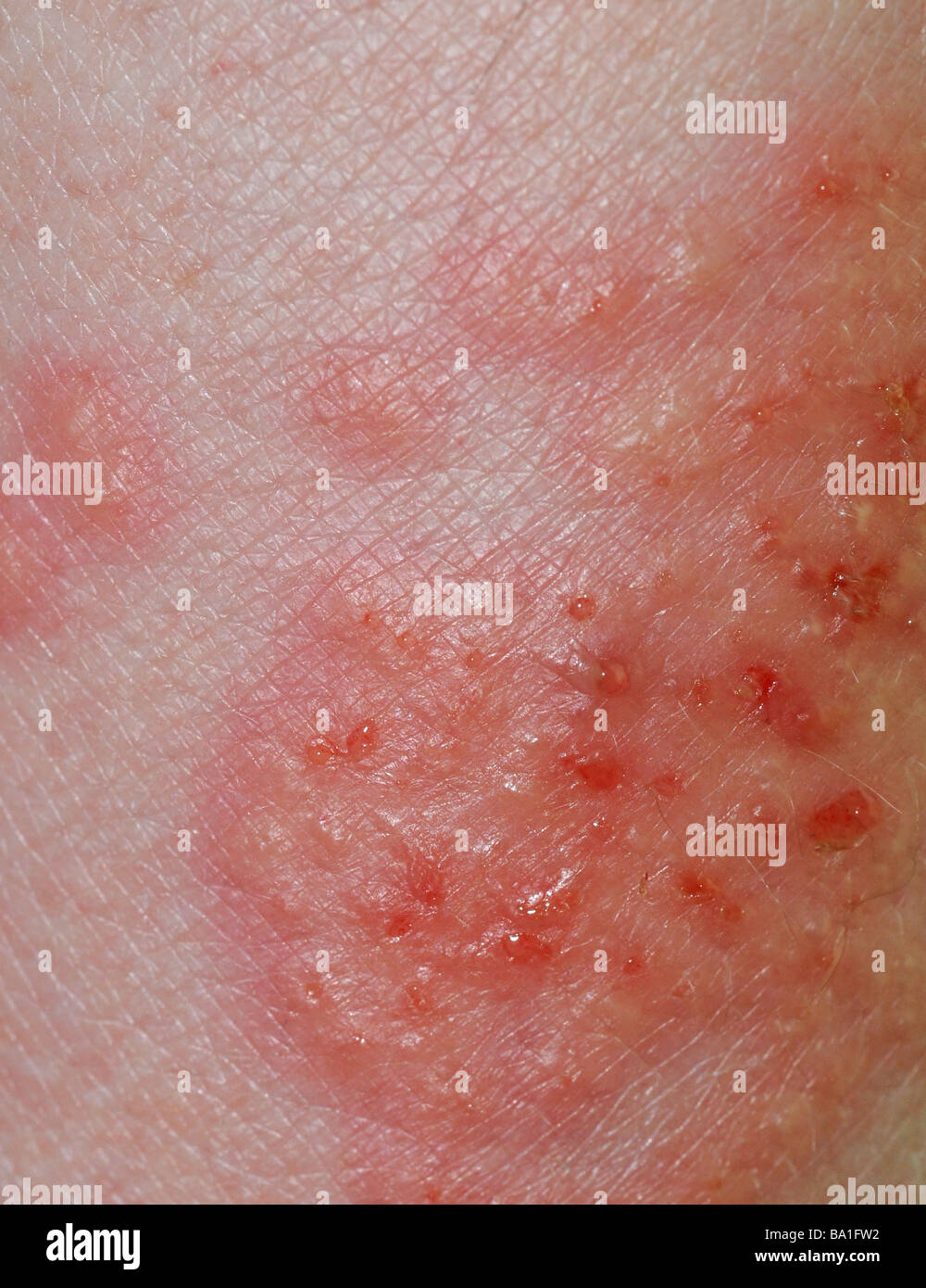 Éruption Maculopapulaire