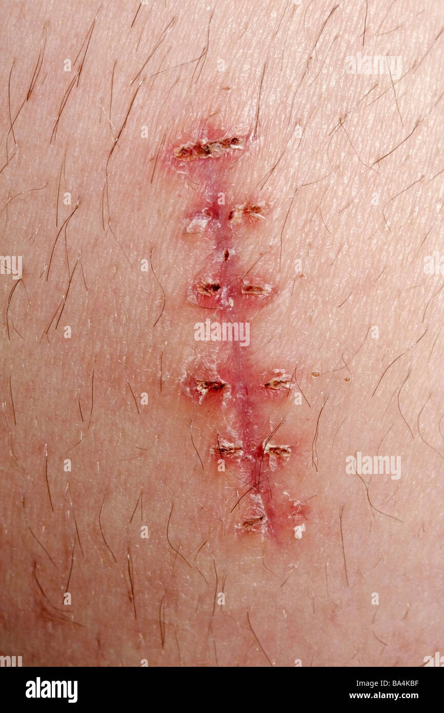 Scar Surgery Banque De Photographies Et Dimages à Haute Résolution Alamy