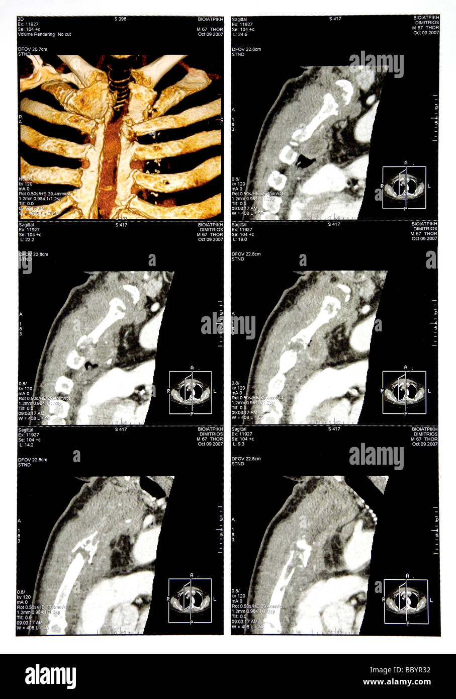 Anatomie du thorax humain Banque de photographies et d’images à haute ...
