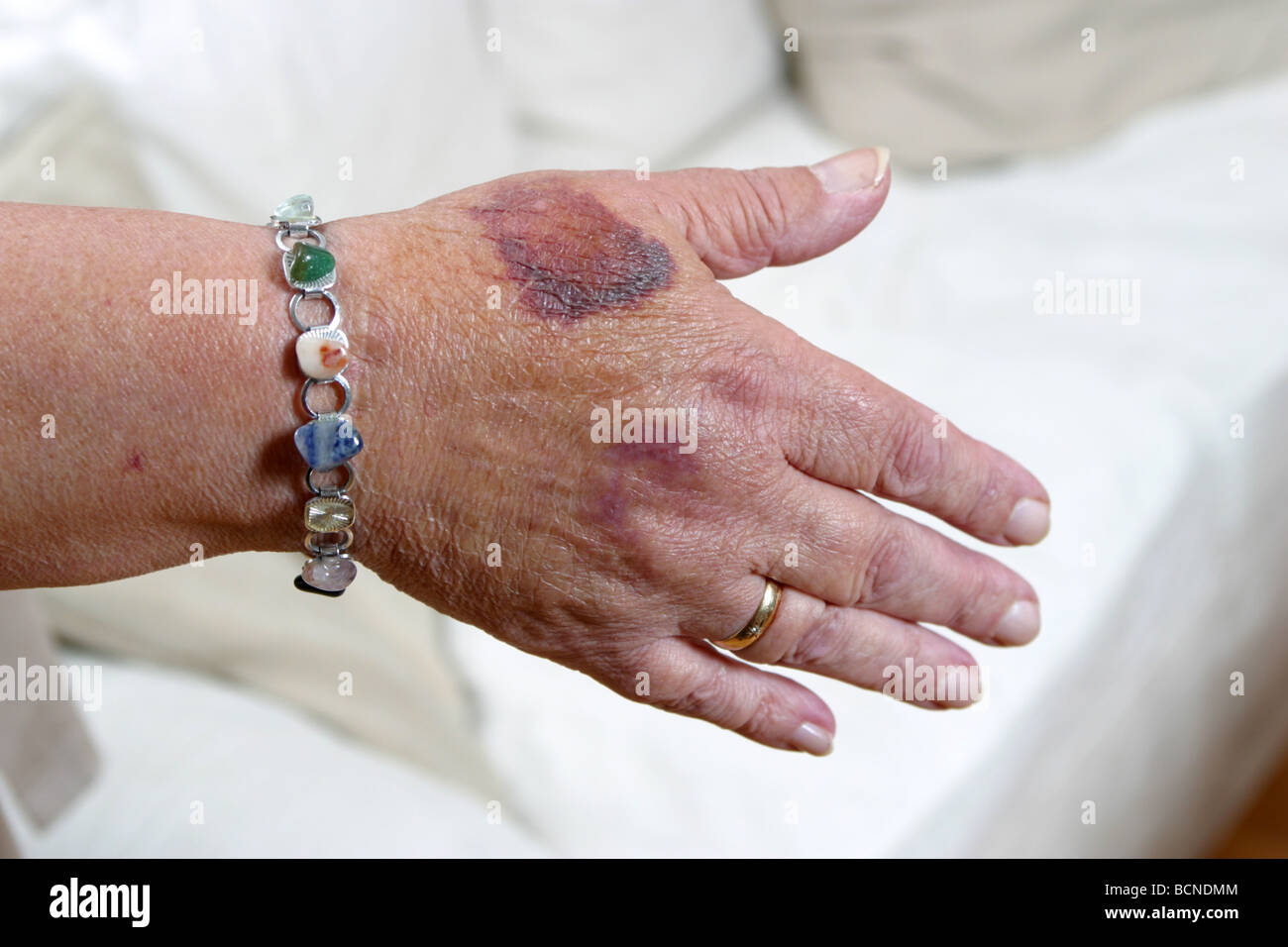 Ecchymoses sur la haute main Photo Stock - Alamy