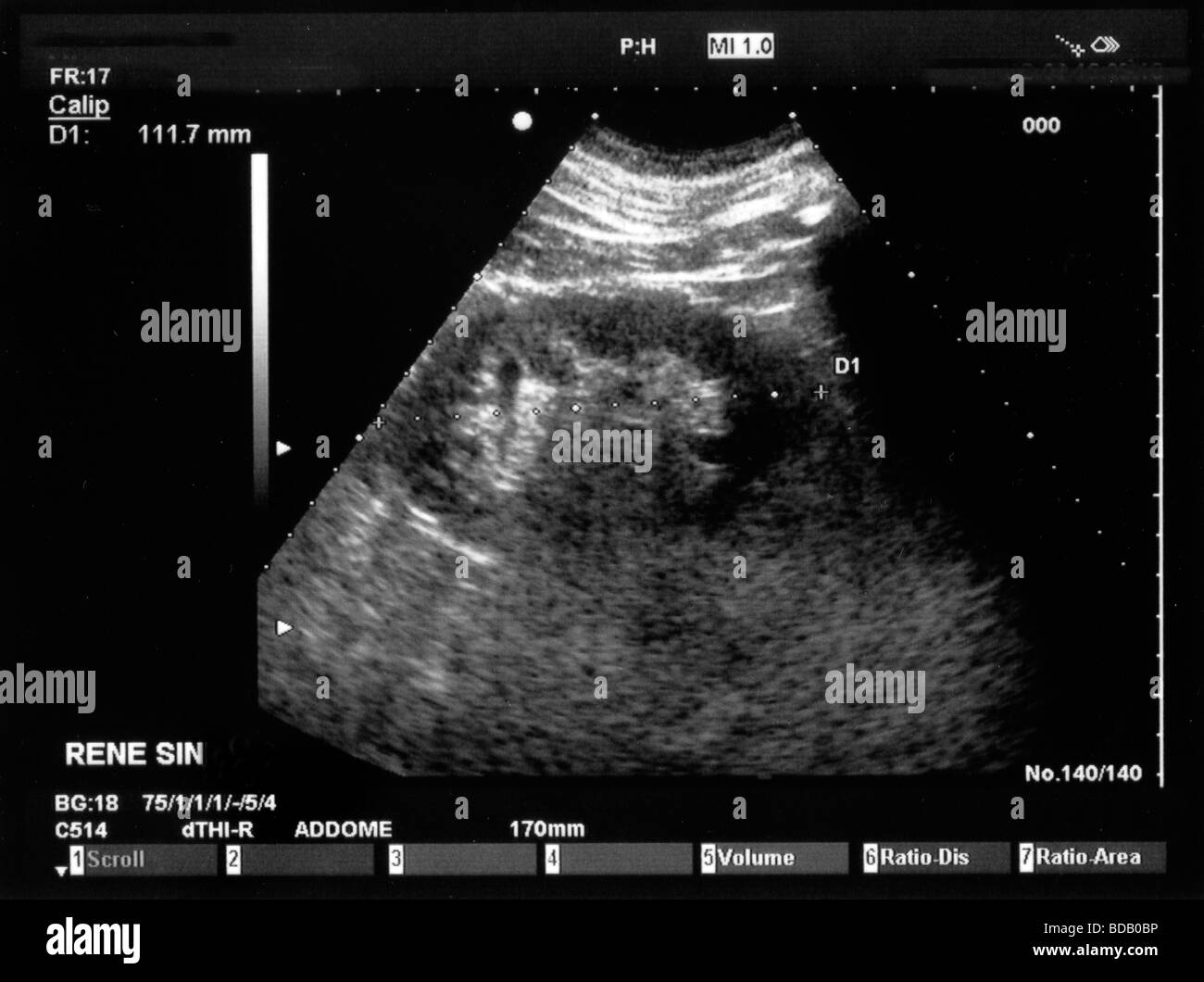 Echographie Du Rein Gauche | Echographie Rénale Fonctionnement – XZYK