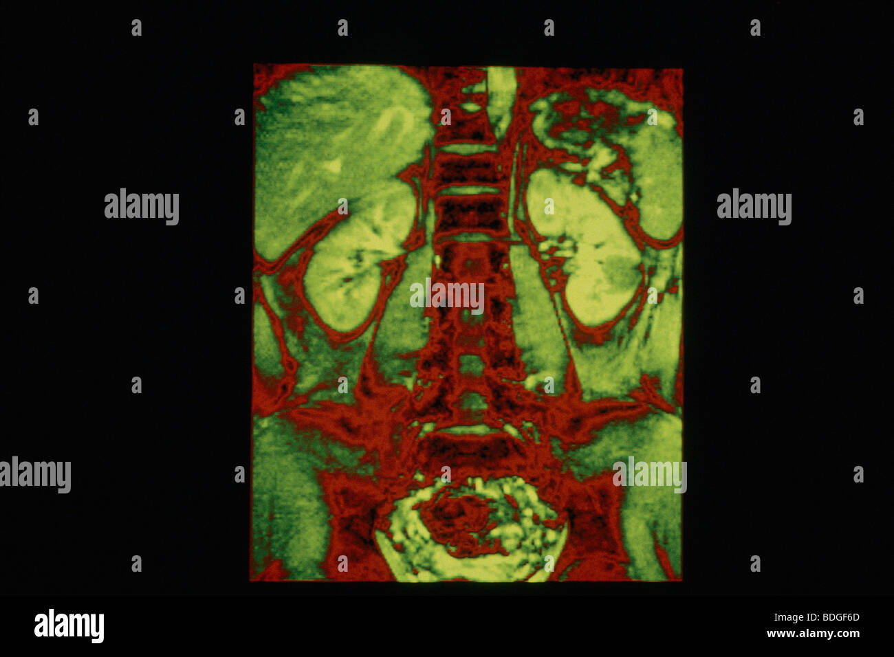 Kidney mri Banque de photographies et d’images à haute résolution - Alamy