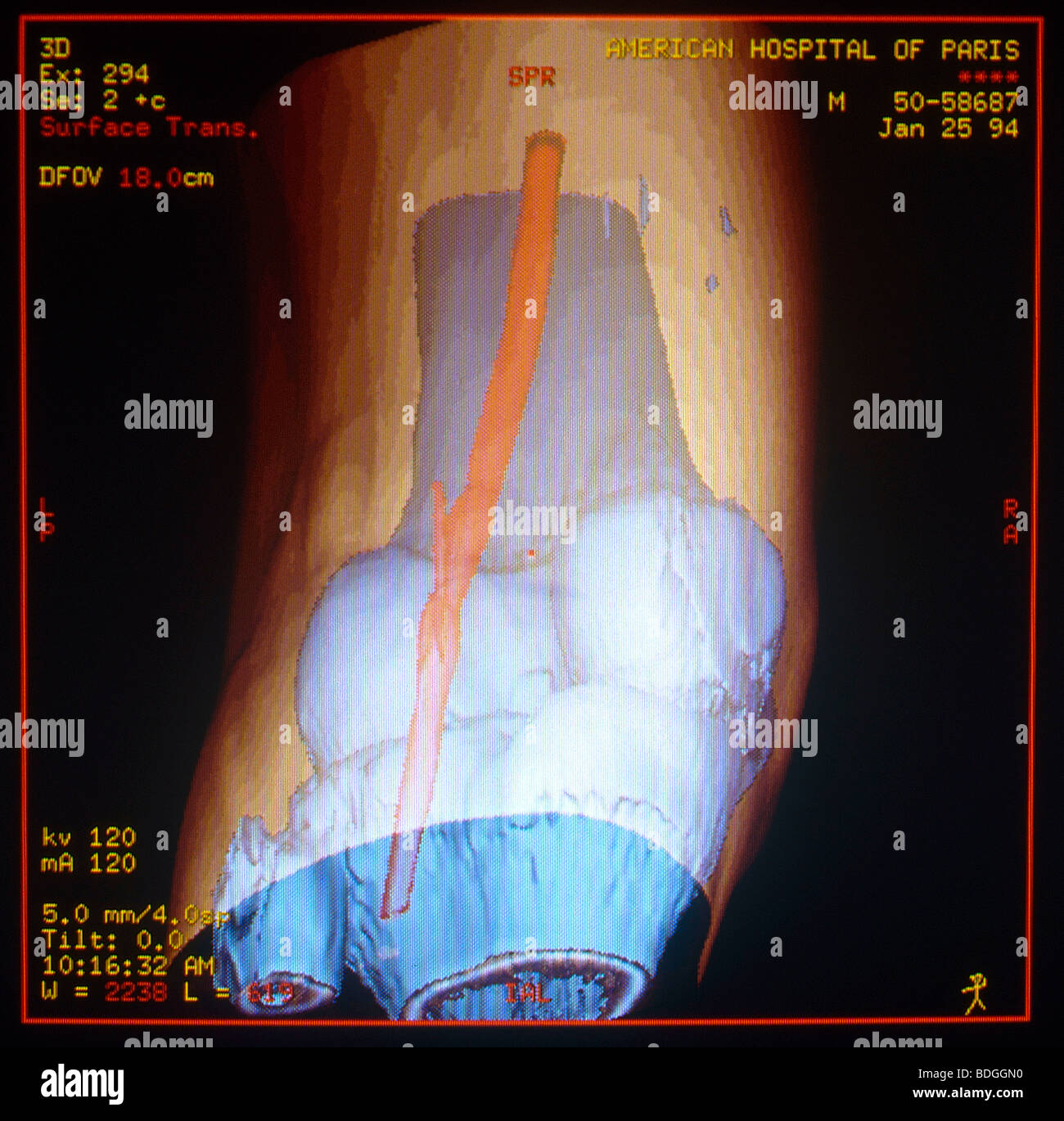 La sténose artérielle, SCAN 3D de l'artère poplitée Photo Stock - Alamy
