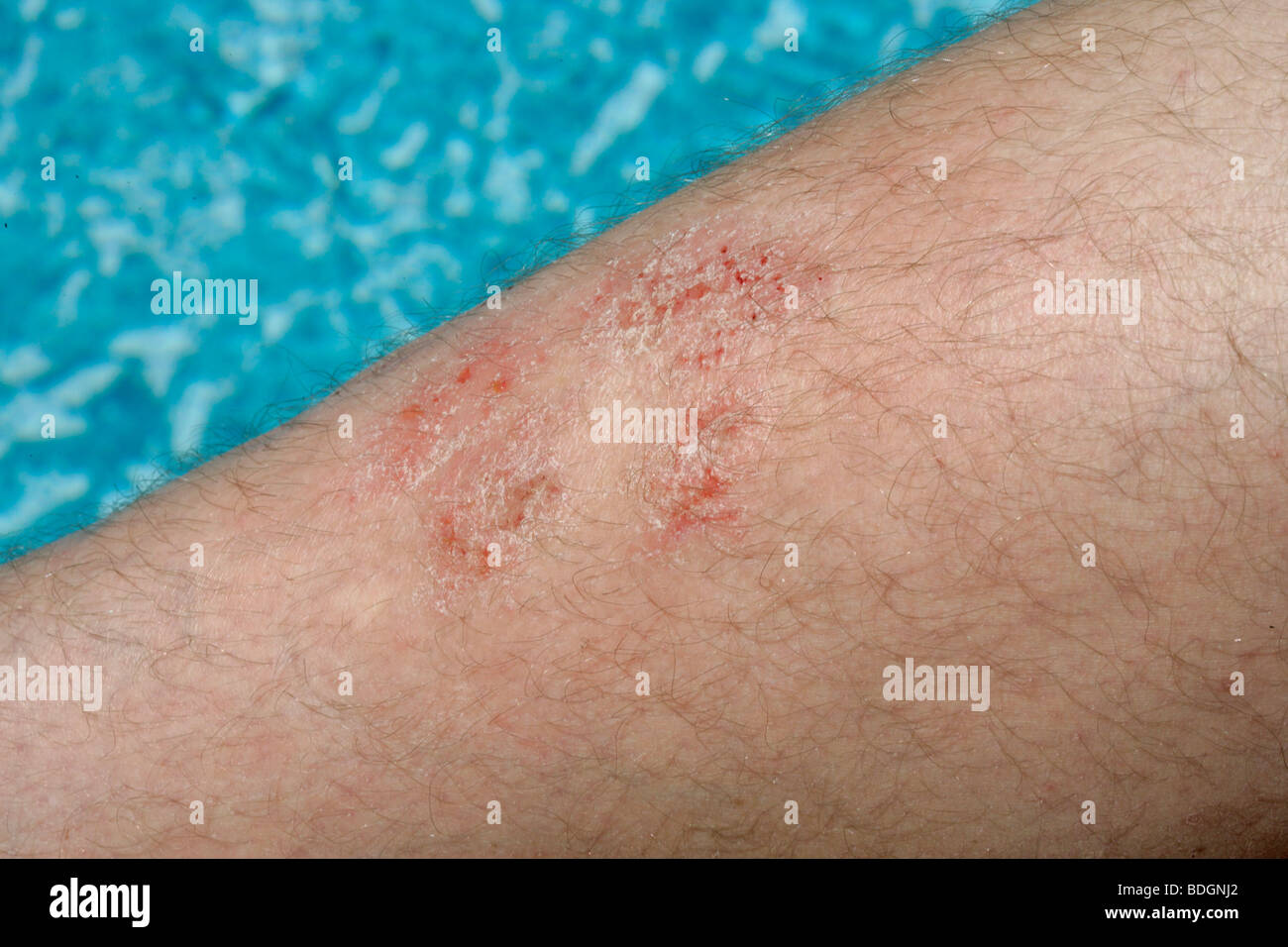 Psoriasis Skin Photos & Psoriasis Skin Images - Alamy