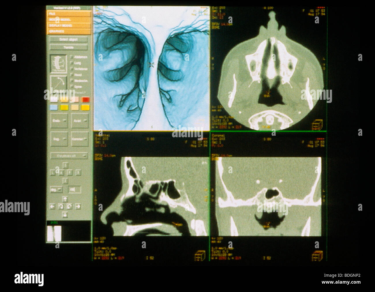 Sinus ct scan Banque de photographies et d’images à haute résolution ...