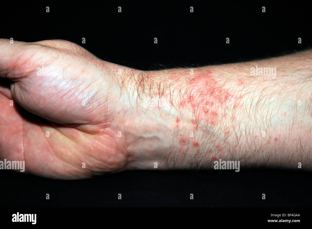 Hives rash Banque de photographies et d’images à haute résolution - Alamy