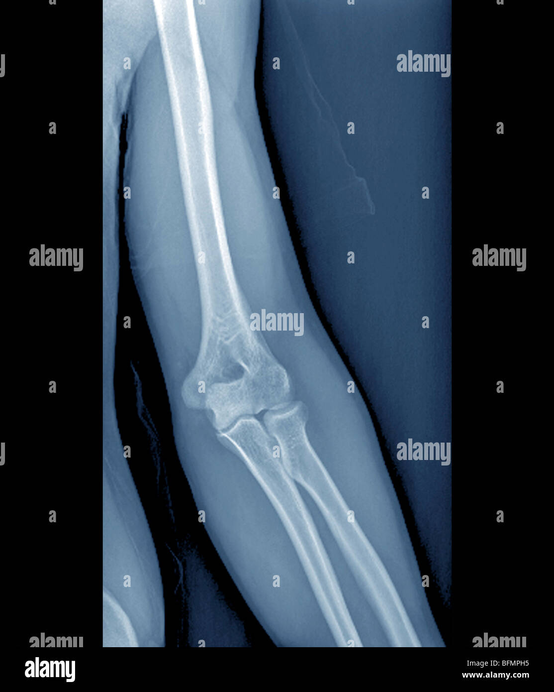 Coudes anatomie Banque de photographies et d’images à haute résolution ...