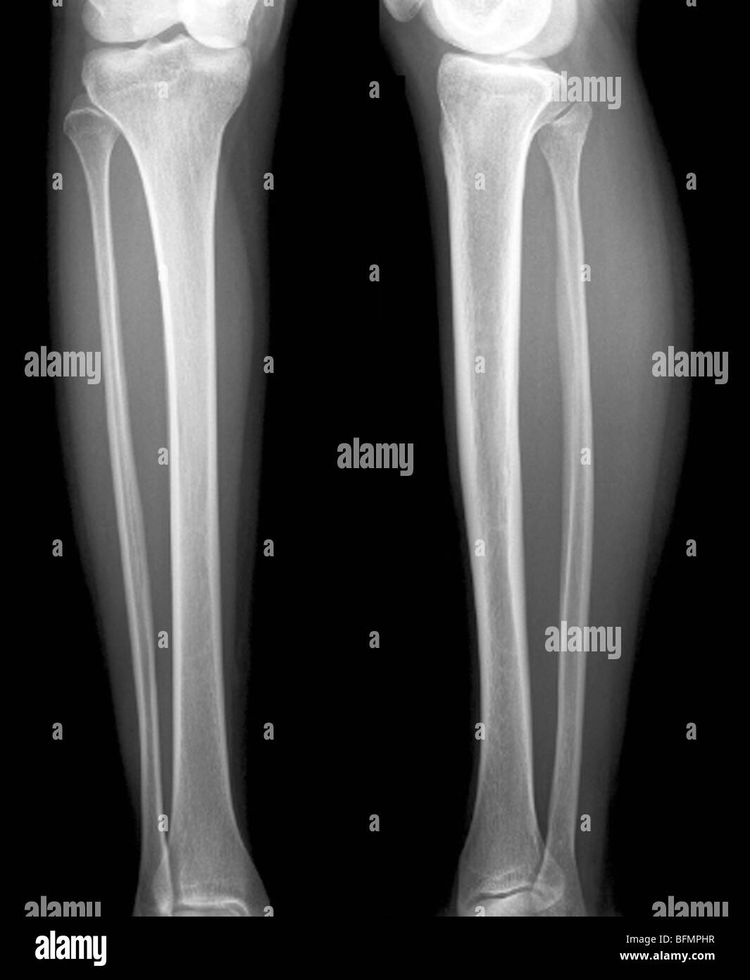 Anatomie de la jambe Banque d'images noir et blanc - Alamy