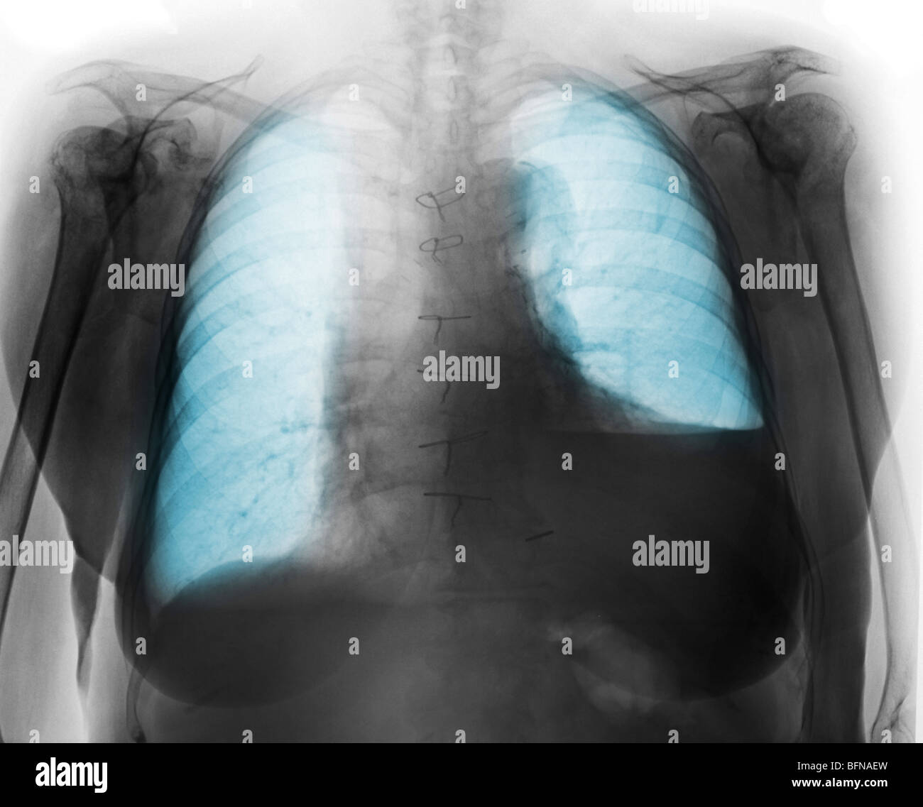 Radiographie d'une vieille femme de 84 ans avec un petit épanchement ...