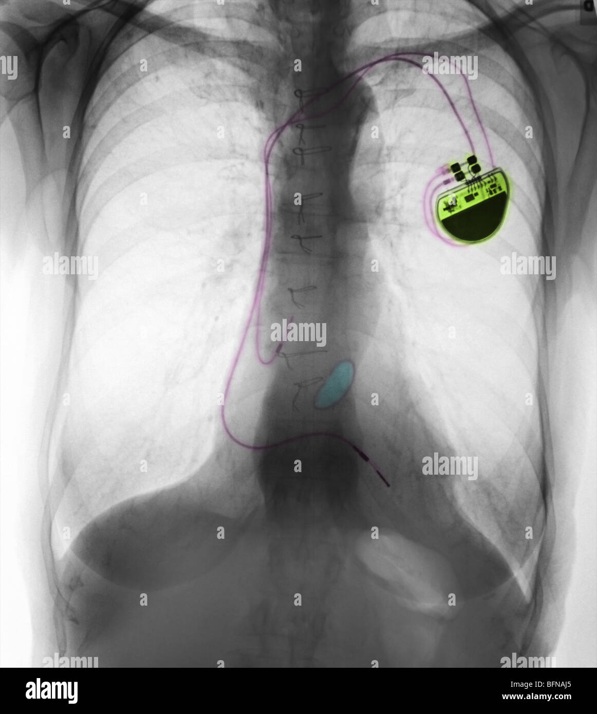 Chest x ray valve pacemaker Banque de photographies et d’images à haute ...