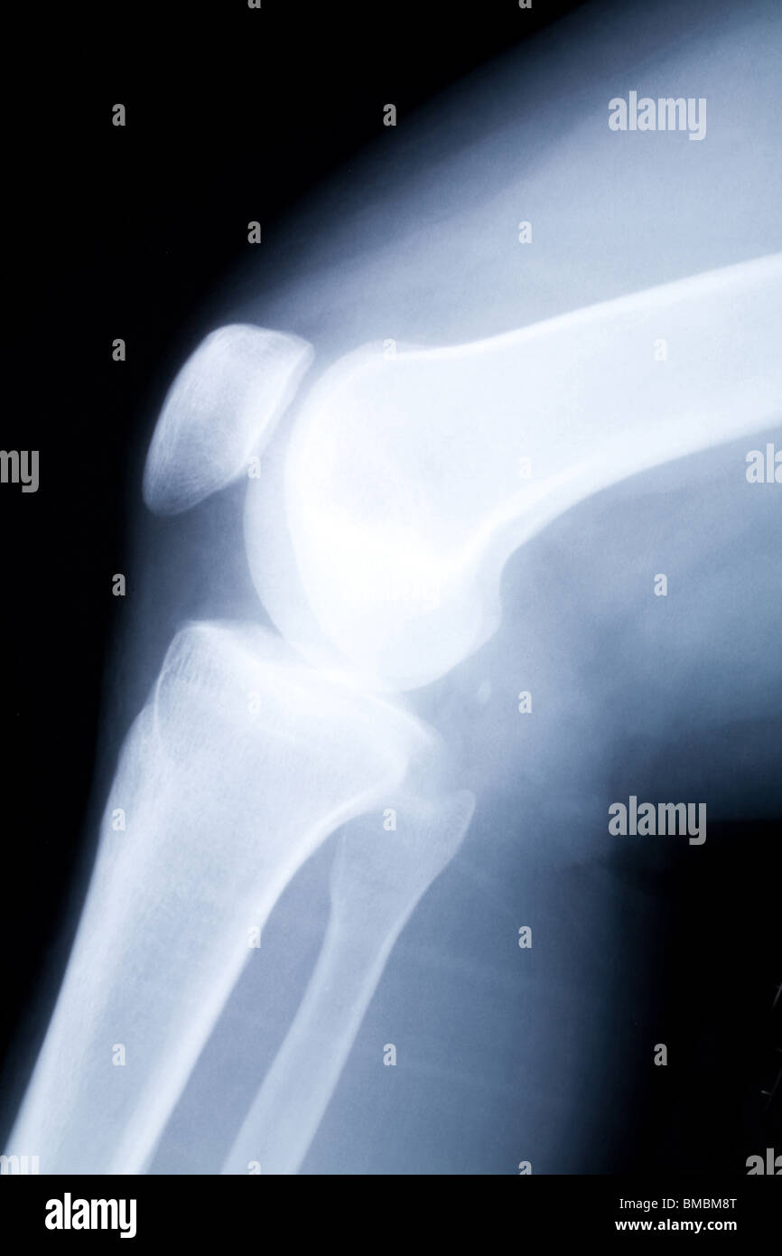 Radiographie du genou Banque de photographies et d’images à haute ...