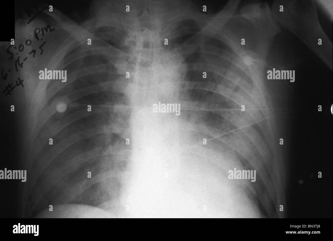 Radiographie montrant une infection de peste pulmonaire impliquant les ...