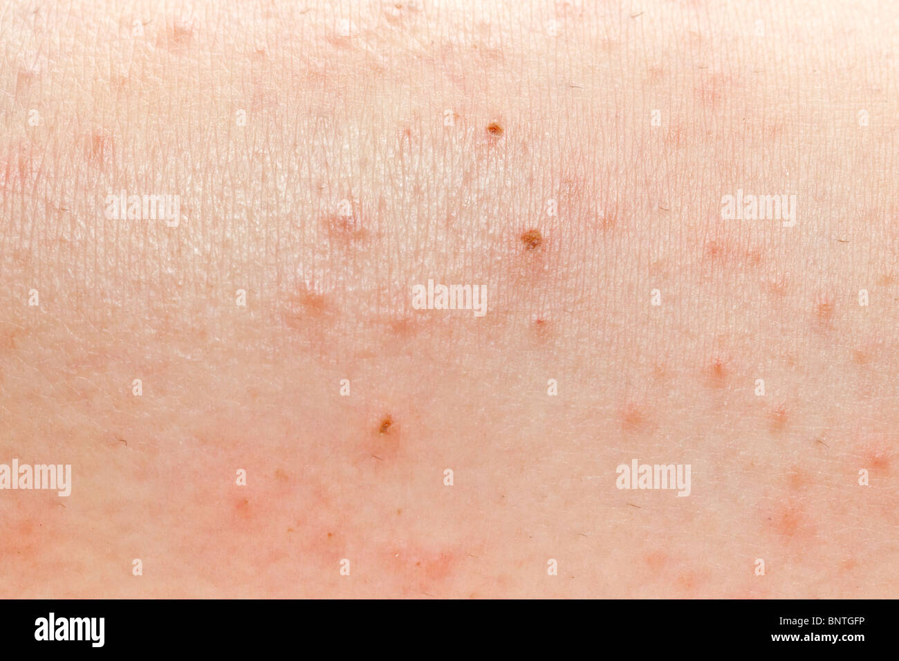 Tache rouge peau Banque de photographies et d’images à haute résolution ...