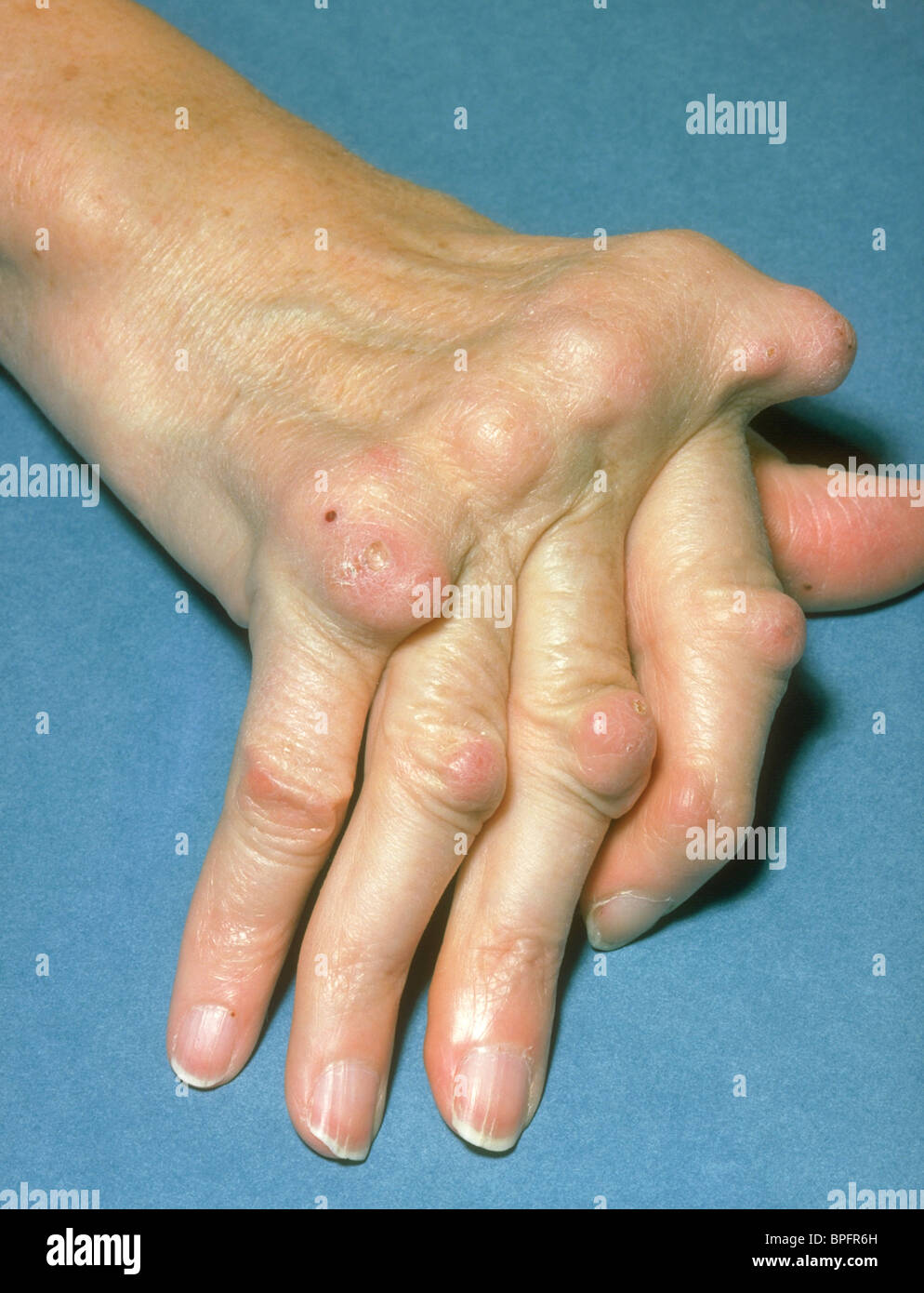 La main d'un patient avec l'inflammation des vaisseaux sanguins ...
