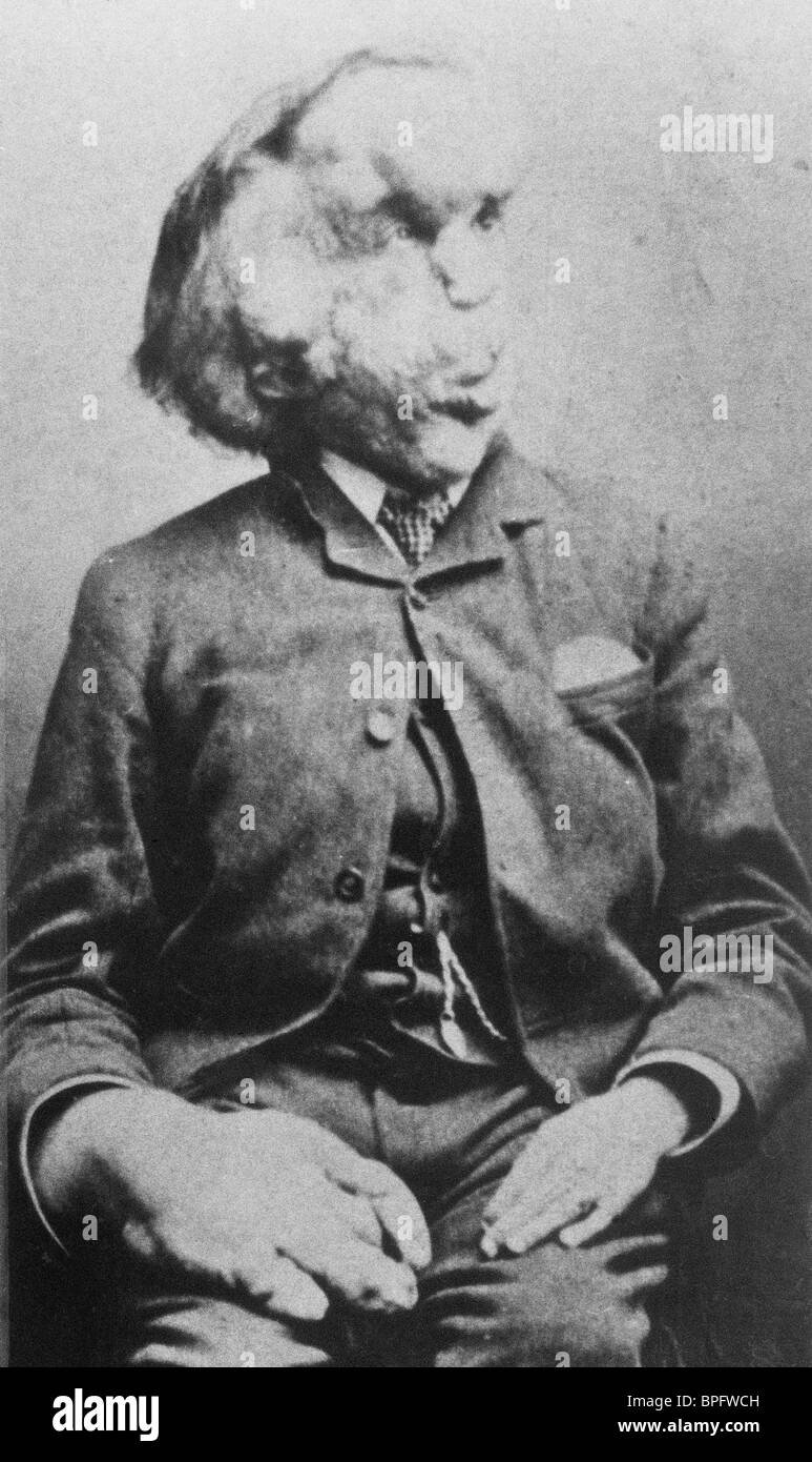 JOSEPH MERRICK - L'ELEPHANT MAN Photo Stock - Alamy