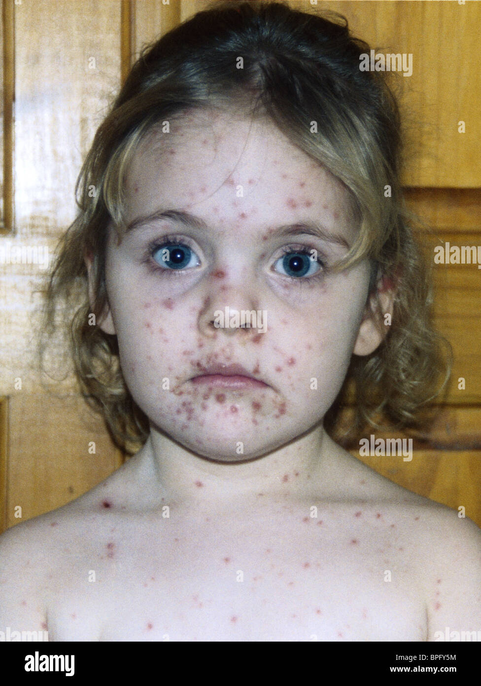 Les lésions de la varicelle sur le visage Photo Stock - Alamy