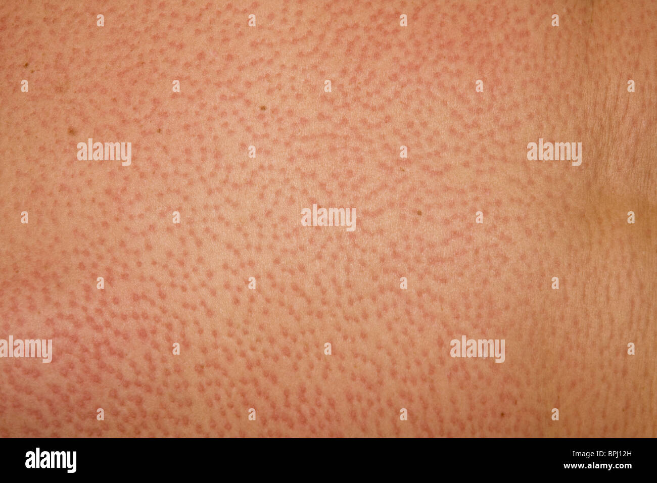 Taches rouges sur le dos d'une femme, après avoir couché sur un tapis ...