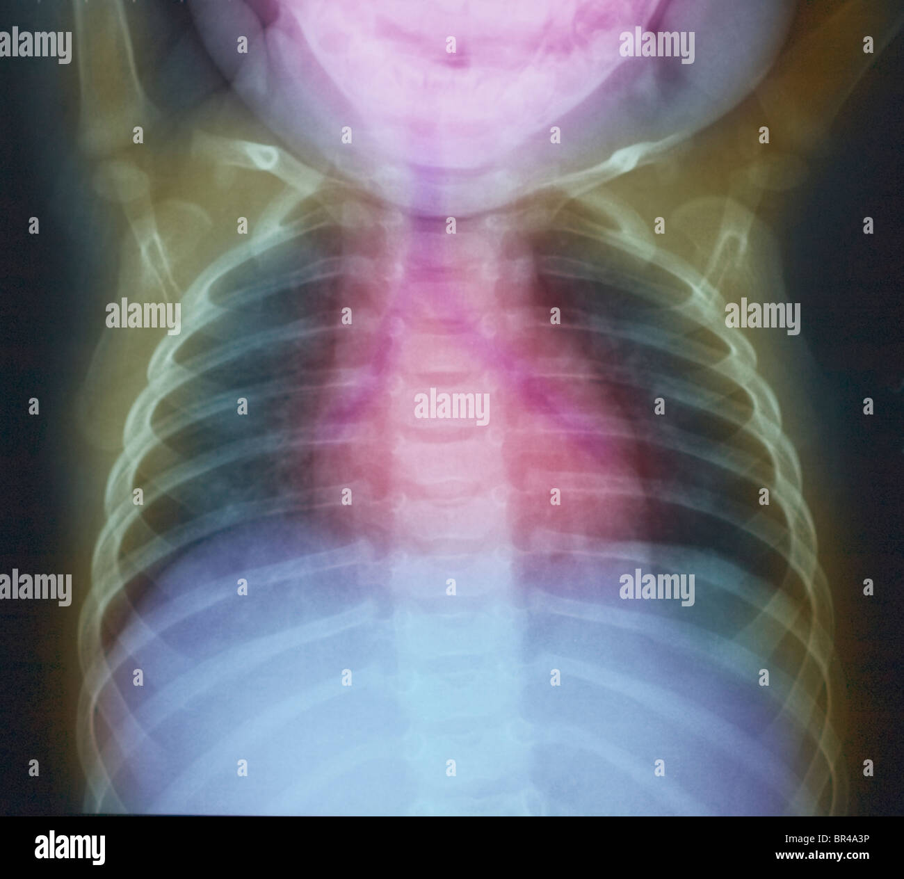 La radiographie du thorax normale d'un garçon de 7 mois Photo Stock - Alamy