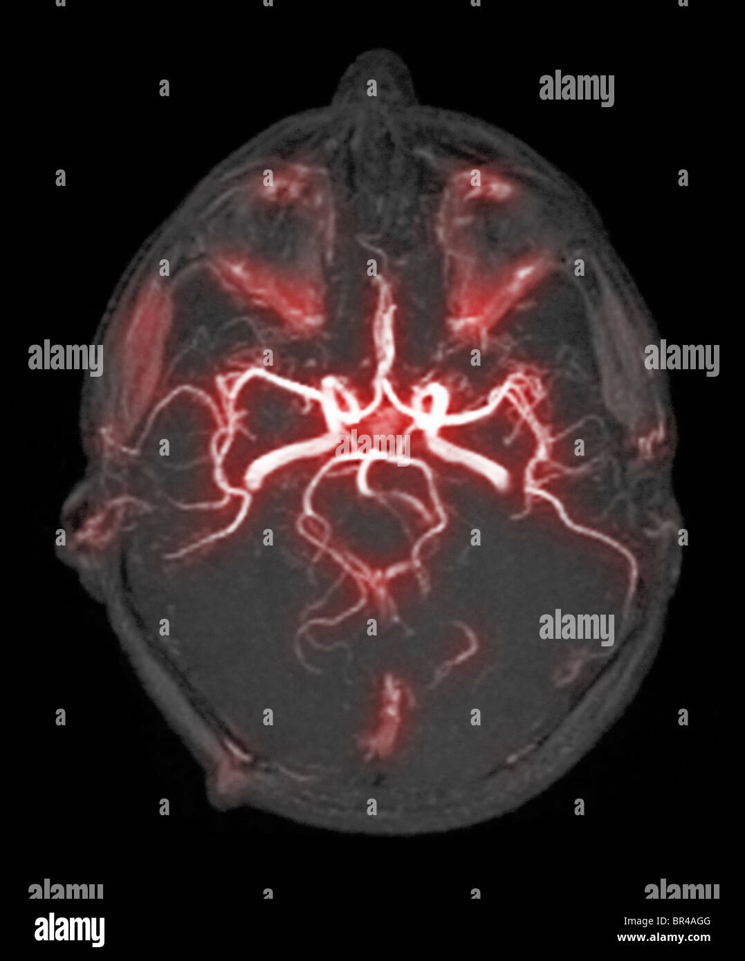 Angiogramme d'un homme de 34 ans, montrant un cercle de Willis, les ...