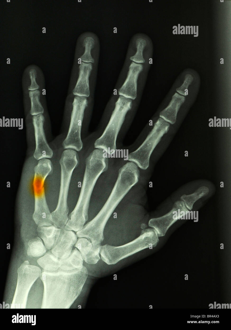 X-ray la main d'un homme de 57 ans montrant un 5e métacarpe (fracture ...