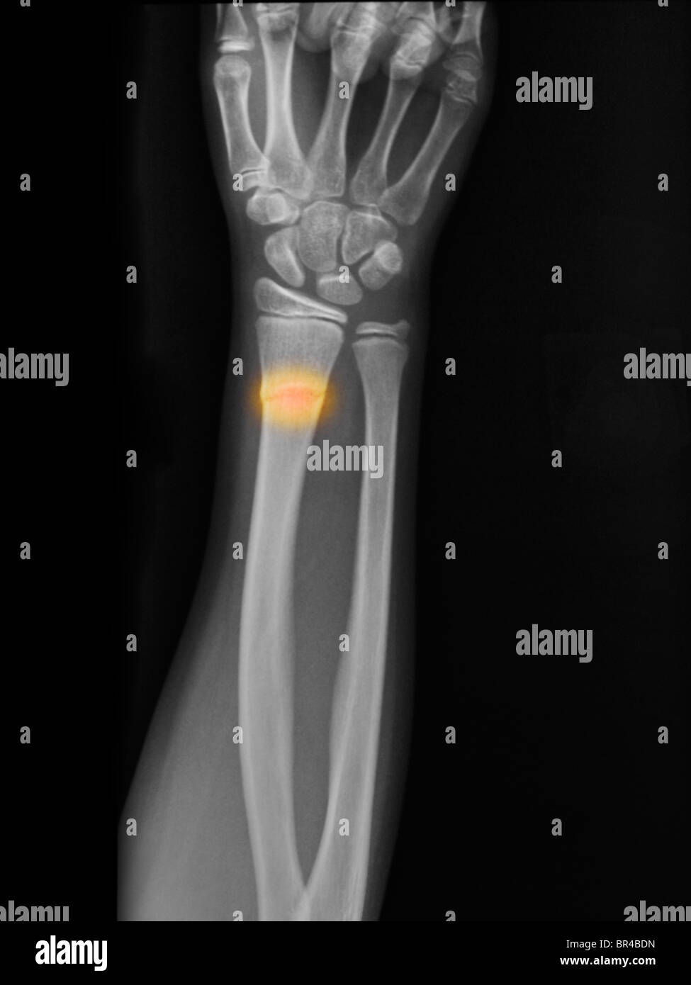 Fracture of radius Banque de photographies et d’images à haute ...