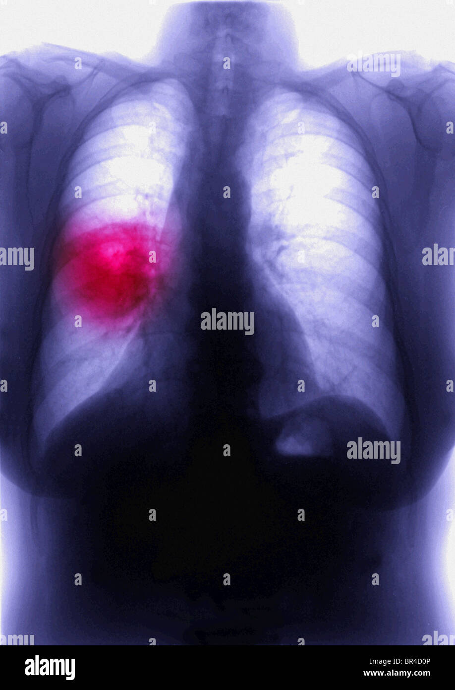 Radiographie montrant phase IIIa carcinome squamous de cellules du ...