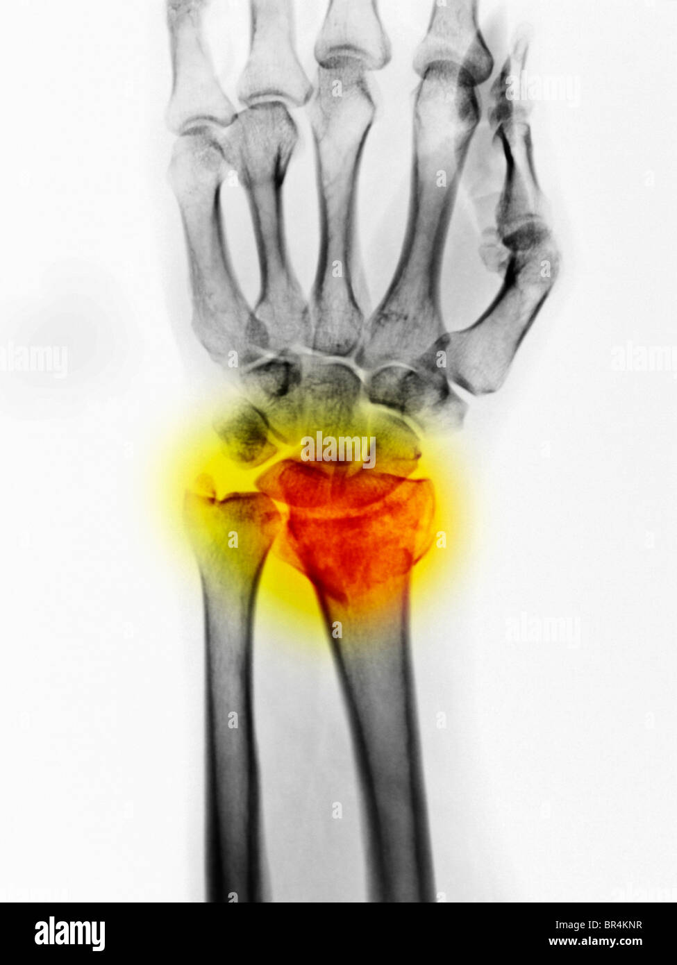 Styloïde ulnaire du radius distal et fracture dans un homme de 43 ans ...